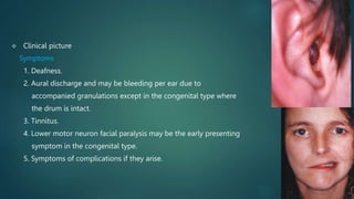 Chronic suppurative otitis media.pptx