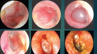 Chronic suppurative otitis media.pptx
