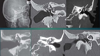 Chronic suppurative otitis media.pptx