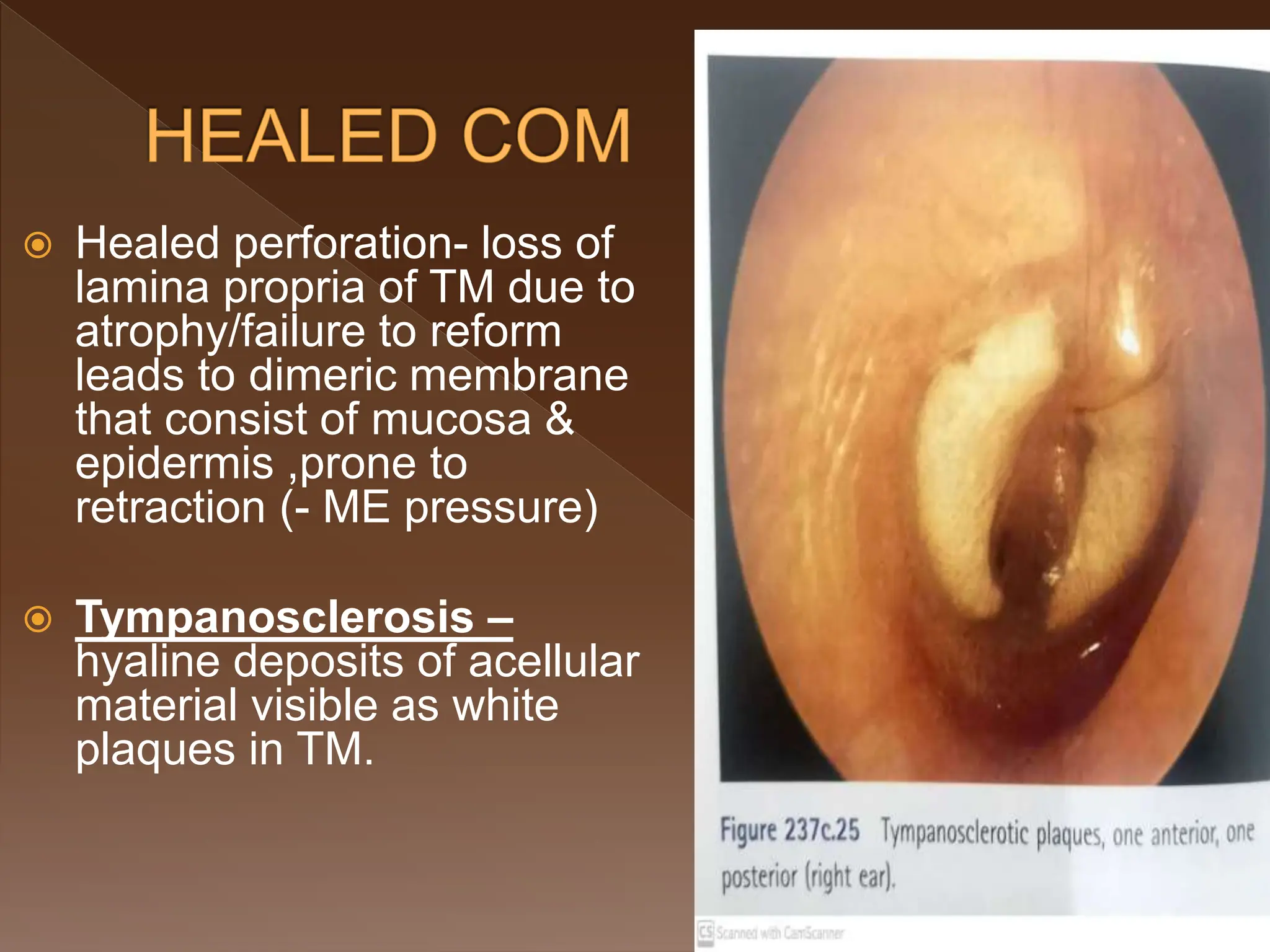 Chronic suppurative otitis media disease of ear .pptx | Ear, Nose and Throat Conditions ...