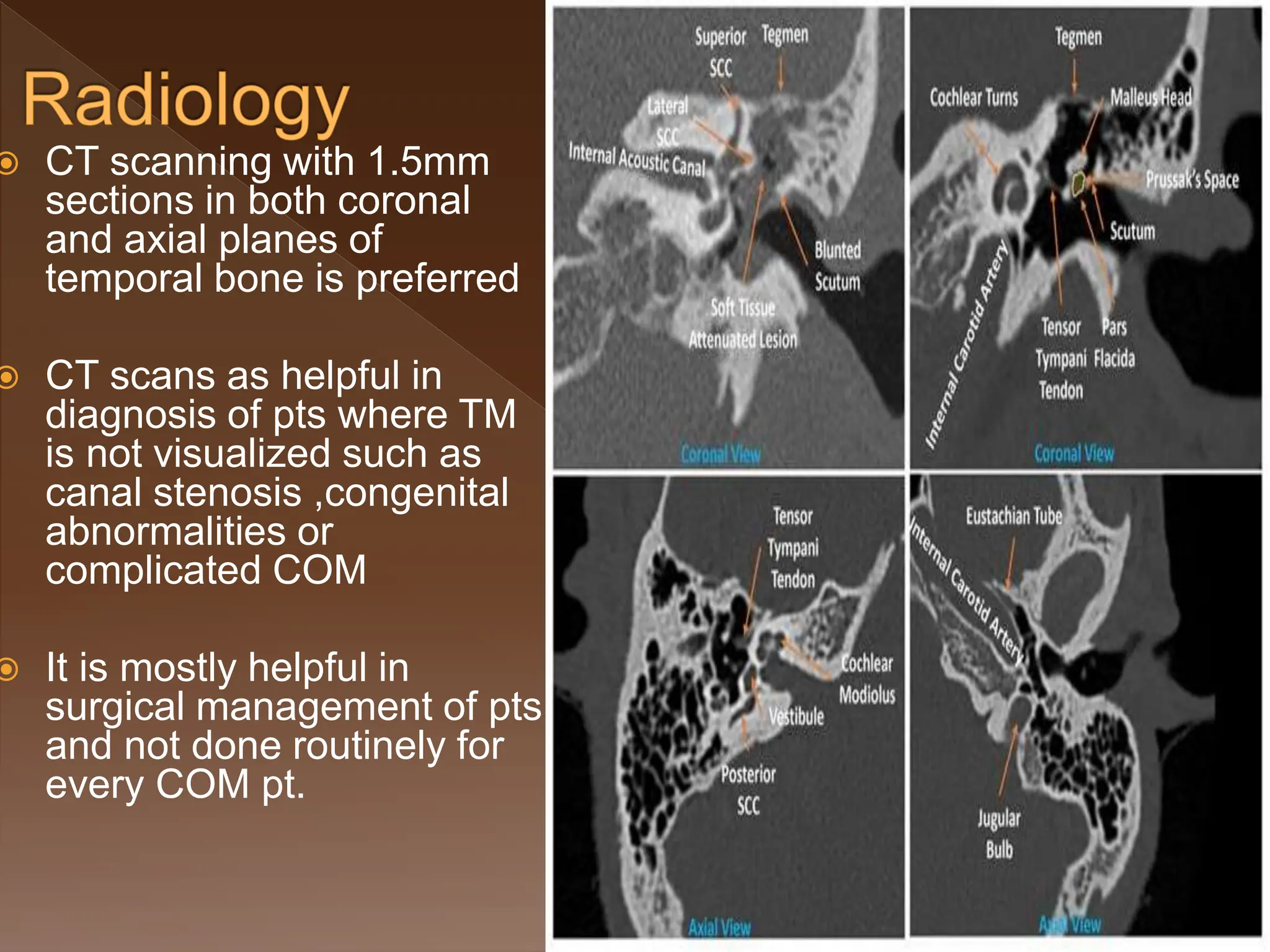 Chronic suppurative otitis media disease of ear .pptx