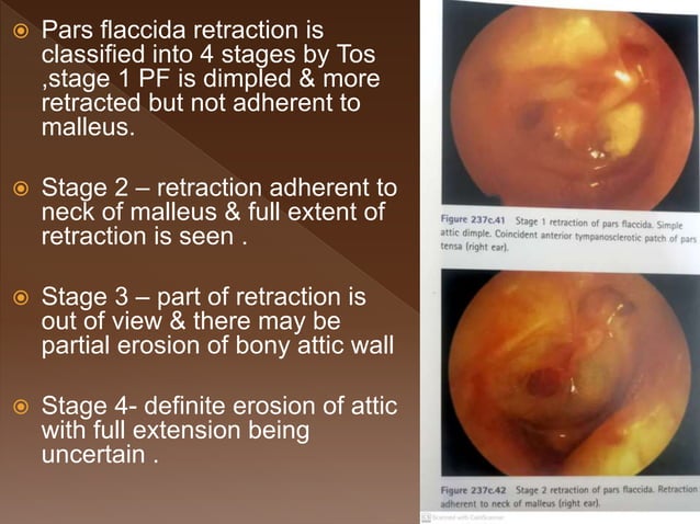 Chronic suppurative otitis media disease of ear .pptx