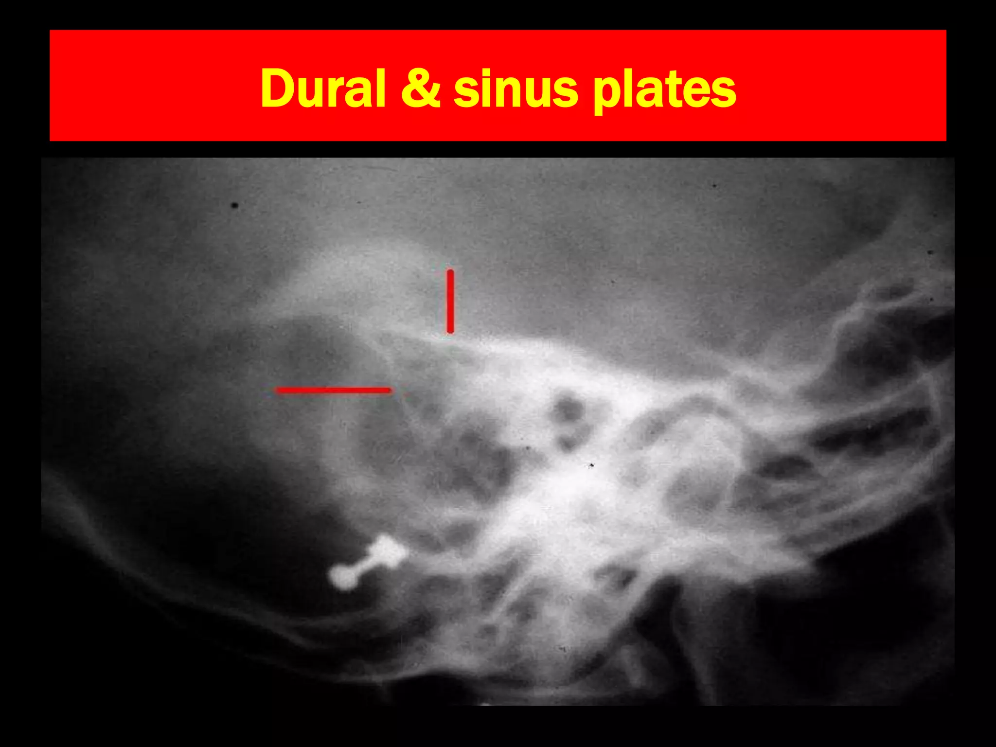 Chronic Suppurative Otitis Media Attico - antral disease.ppt