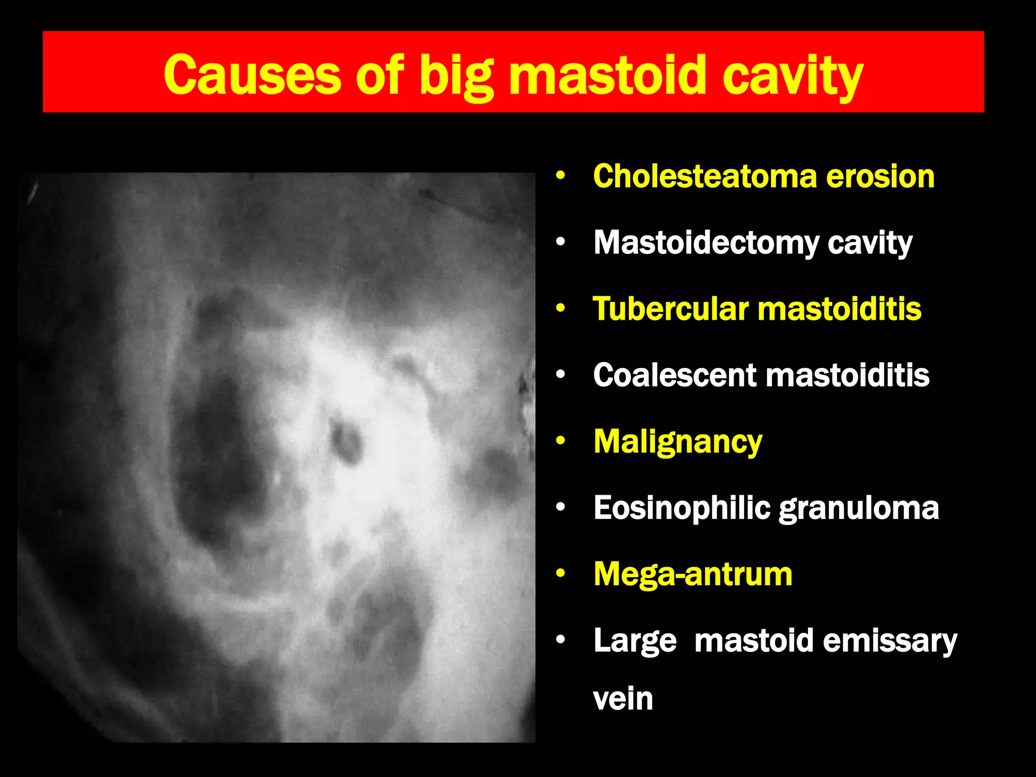 Chronic Suppurative Otitis Media Attico - antral disease.ppt