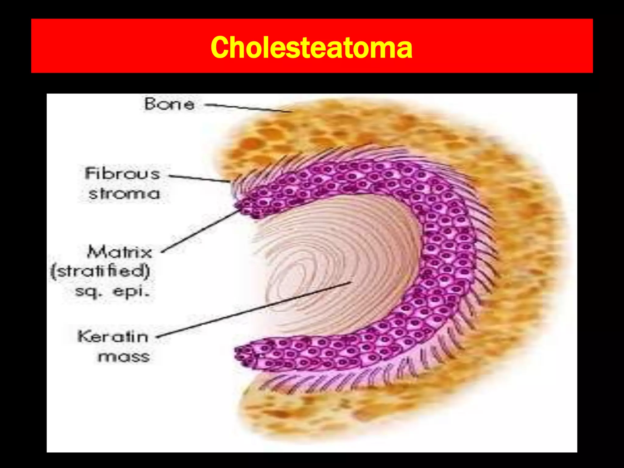 Chronic Suppurative Otitis Media Attico - antral disease.ppt