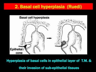 Chronic Suppurative Otitis Media Attico - antral disease.ppt