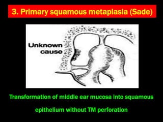 Chronic Suppurative Otitis Media Attico - antral disease.ppt