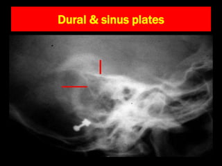 Chronic Suppurative Otitis Media Attico - antral disease.ppt