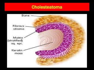 Chronic Suppurative Otitis Media Attico - antral disease.ppt