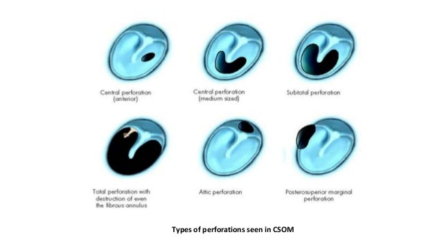 Chronic suppurative otitis media (csom)