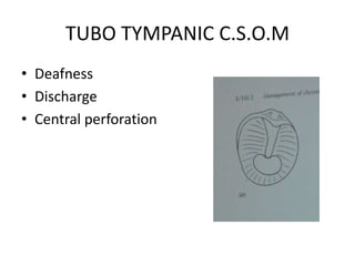 Chronic suppurative otitis media (csom) | PPTX