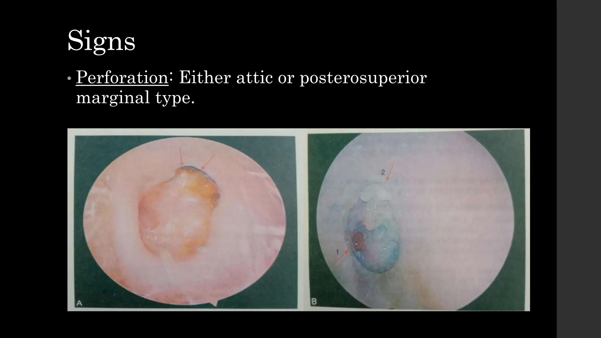 Chronic Suppurative Otitis Media (CSOM) | PPTX | Ear, Nose and Throat ...