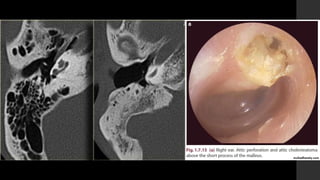 Chronic Suppurative Otitis Media (CSOM) | PPTX | Ear, Nose and Throat ...