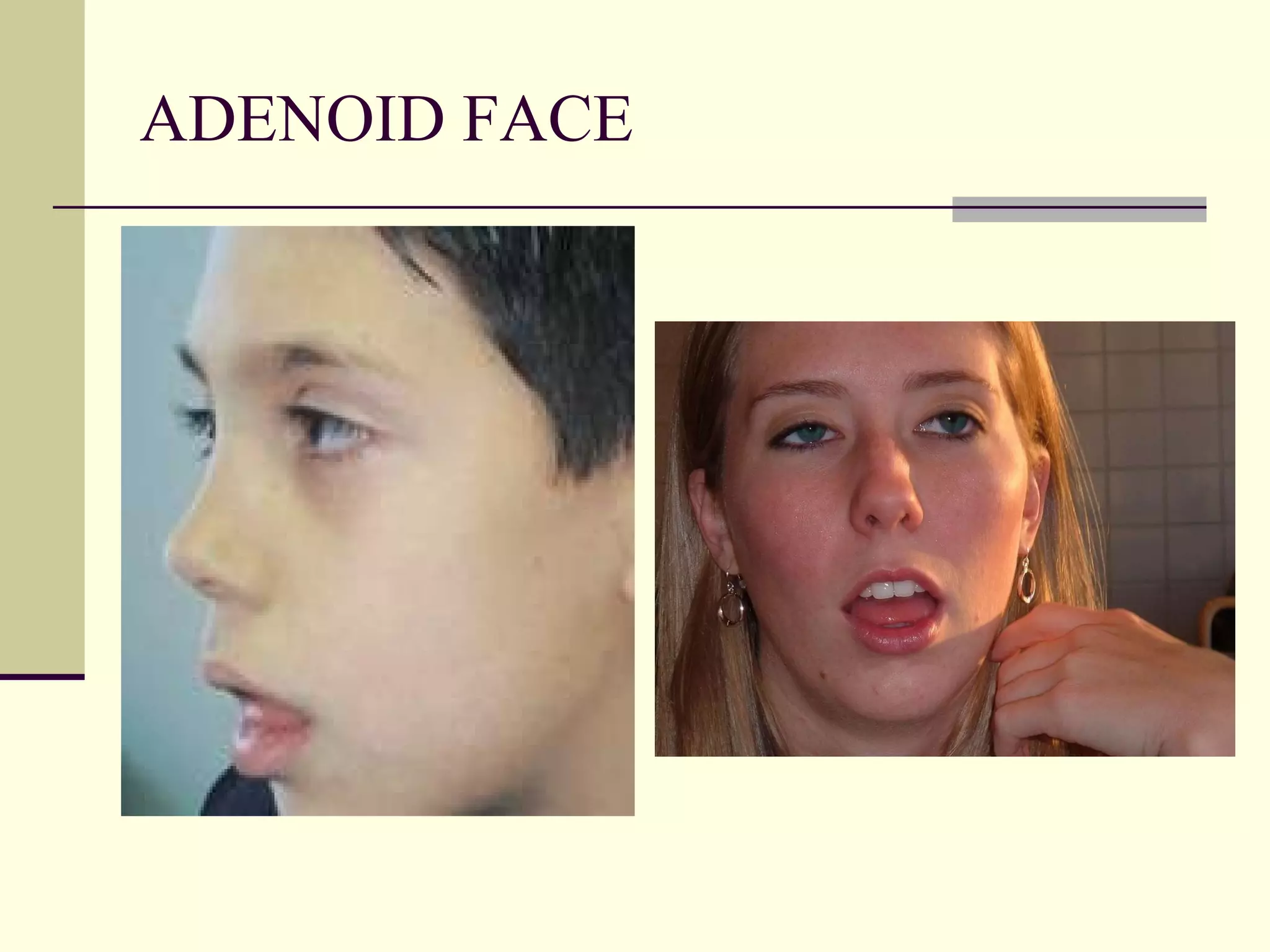 Chronic tonsillitis | PPT