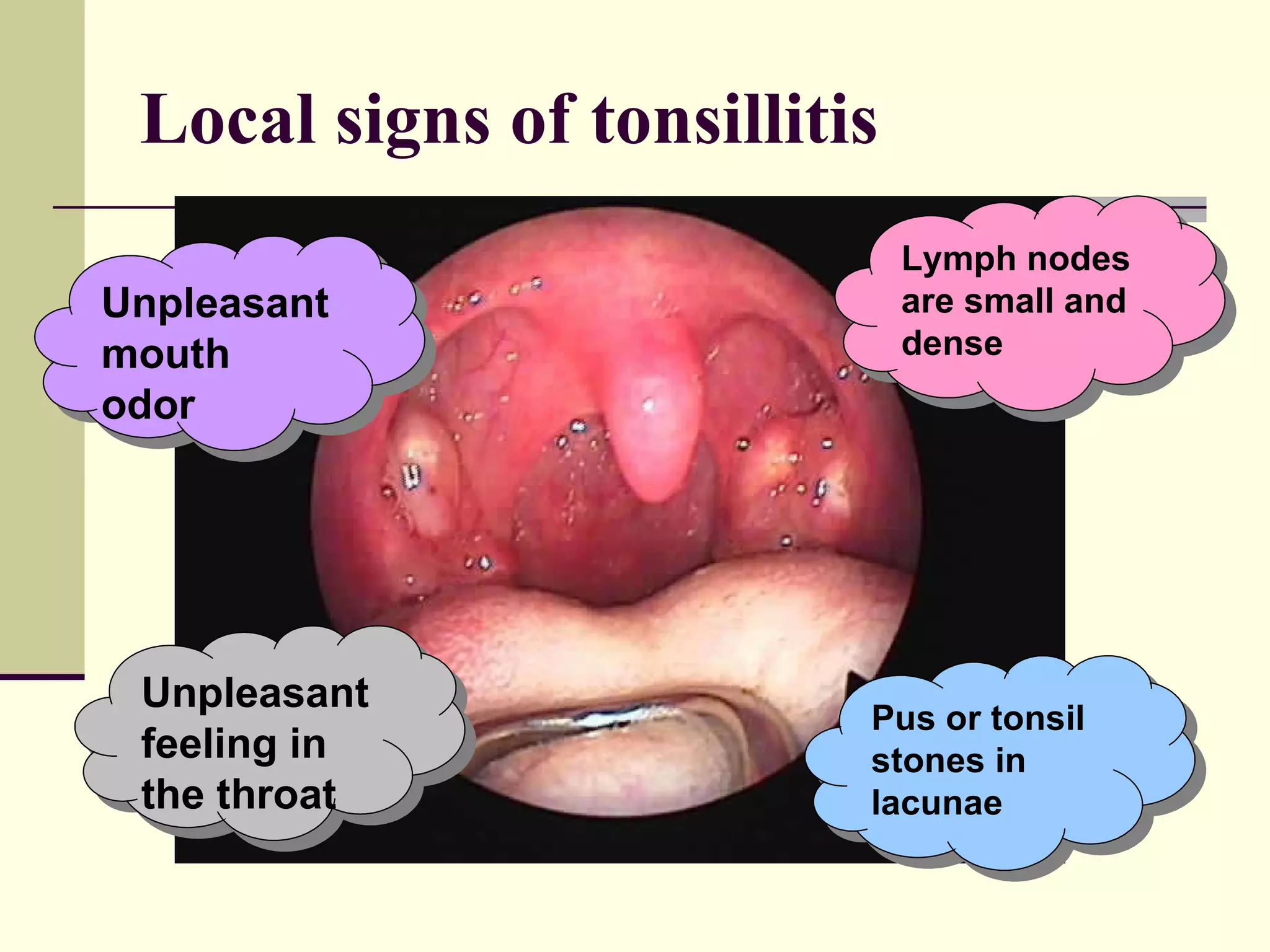 Chronic tonsillitis | PPT