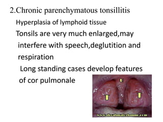 Chronic tonsillitis | PPTX