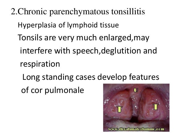 Chronic tonsillitis