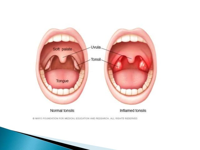 Chronic tonsillitis | PPTX | Ear, Nose and Throat Conditions | Diseases and Conditions