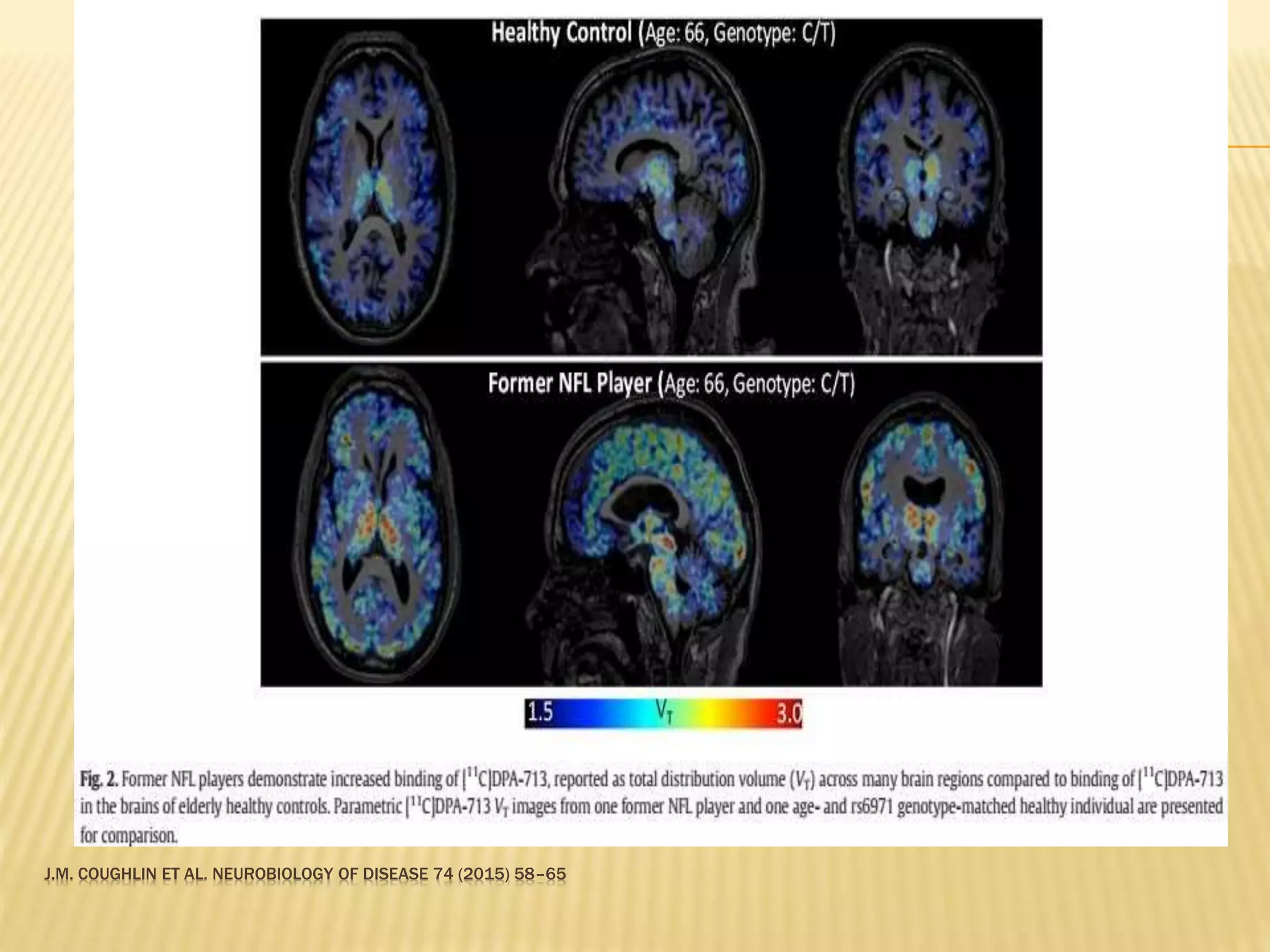 Chronic Traumatic Encephalopathy | PPTX