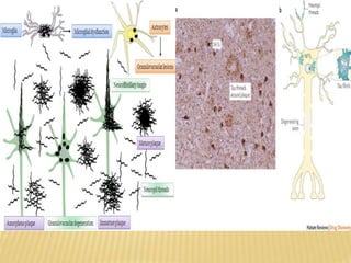 Chronic Traumatic Encephalopathy | PPTX