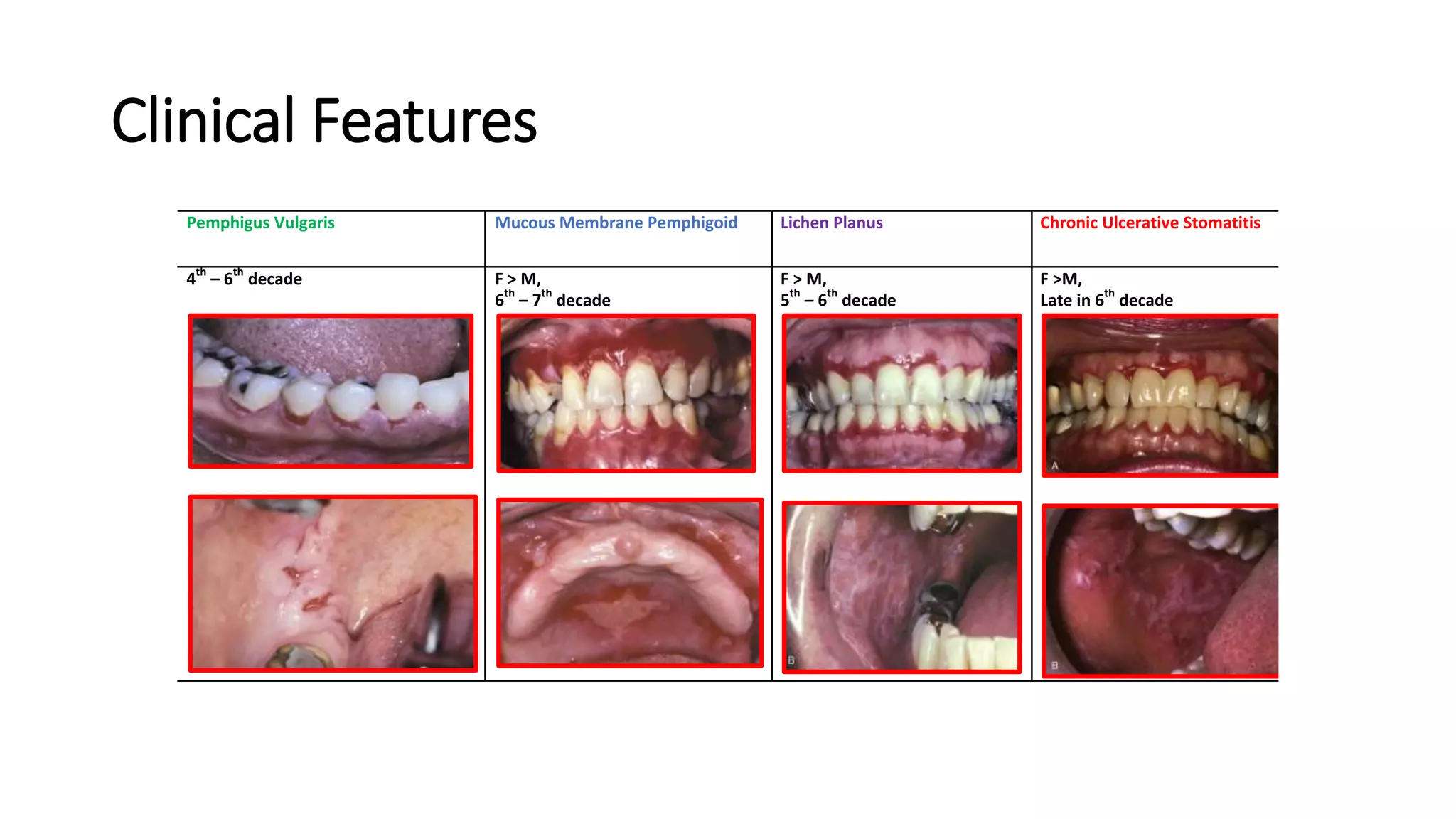 Chronic Ulcerative Stomatitis | PPTX