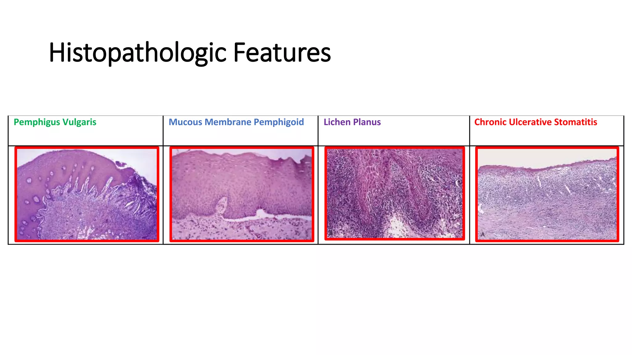 Chronic Ulcerative Stomatitis | PPTX