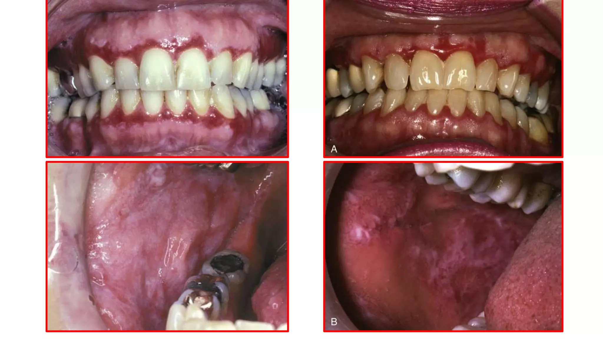 Chronic Ulcerative Stomatitis | PPTX