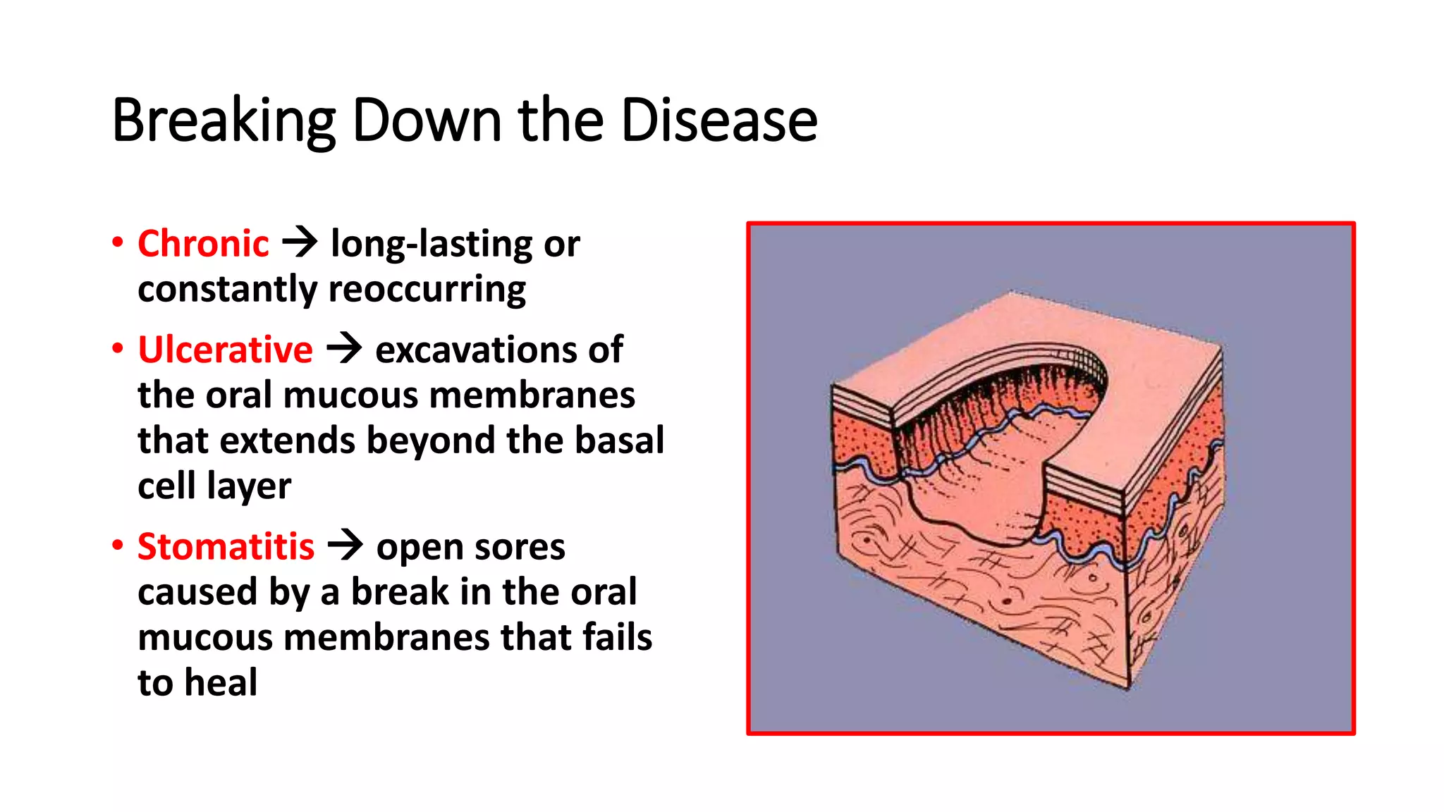 Chronic Ulcerative Stomatitis | PPTX