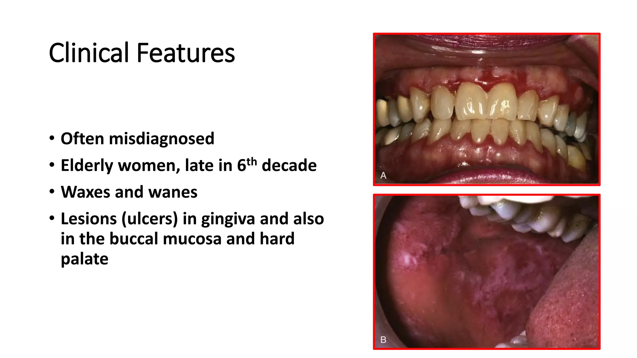Chronic Ulcerative Stomatitis | PPTX