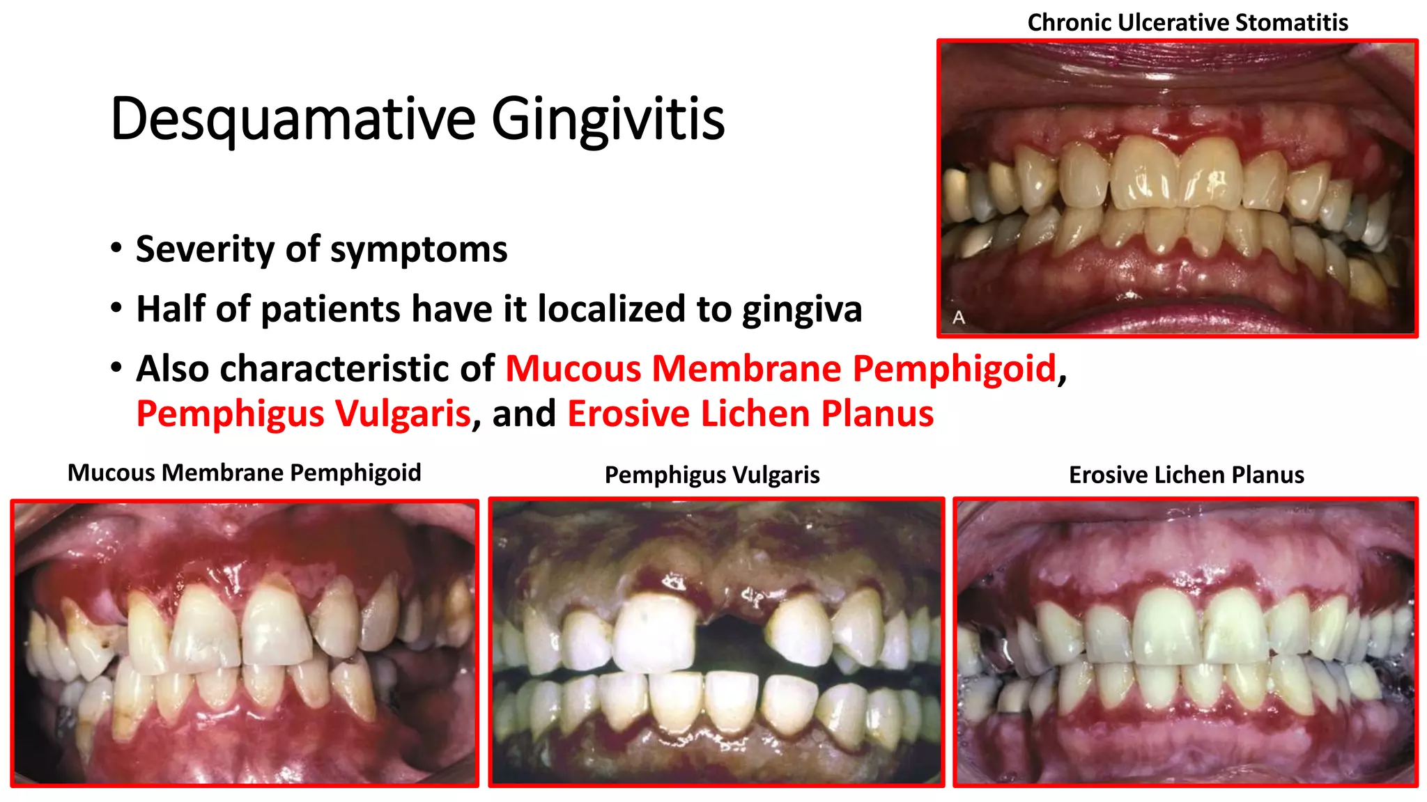 Chronic Ulcerative Stomatitis | PPTX