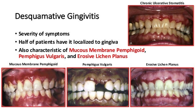 Chronic Ulcerative Stomatitis