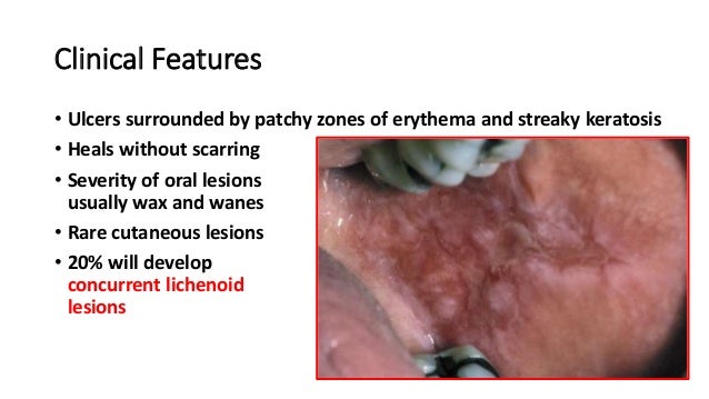 Chronic Ulcerative Stomatitis