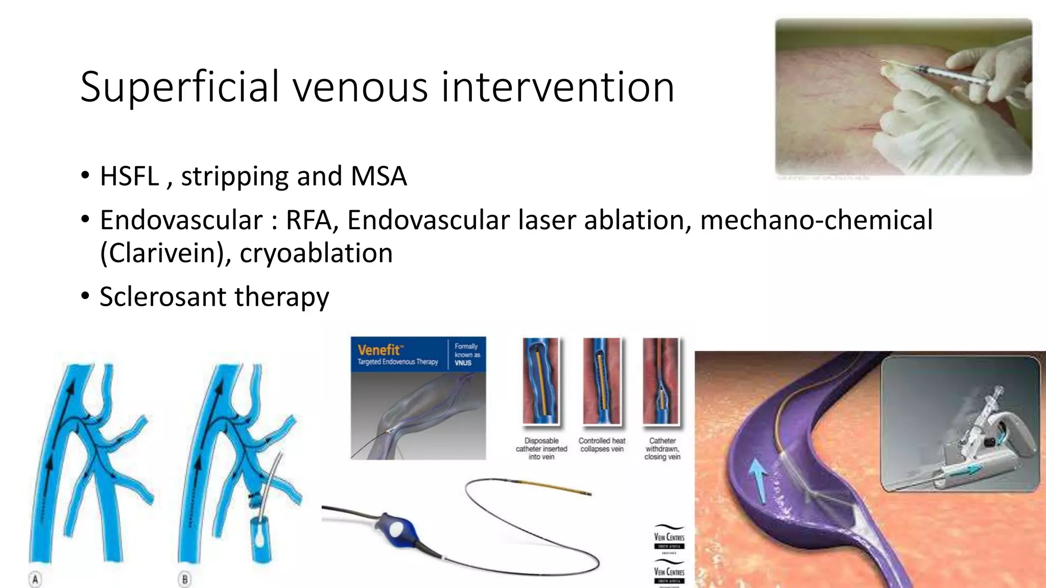 Chronic venous insufficiency | PPTX