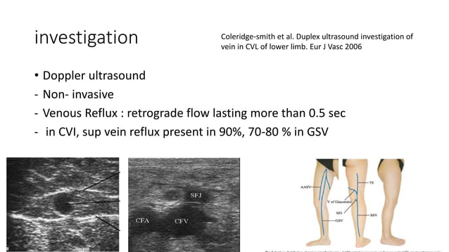 Chronic venous insufficiency | PPTX