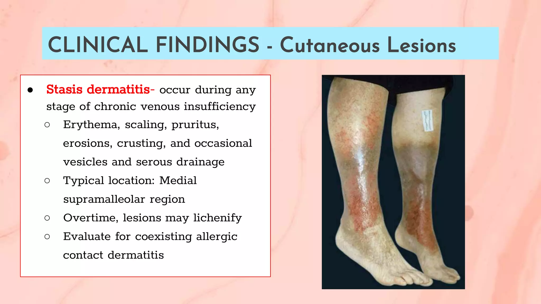 Chronic Venous Insufficiency (drive).pptx