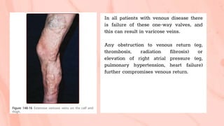 Chronic Venous Insufficiency (drive).pptx