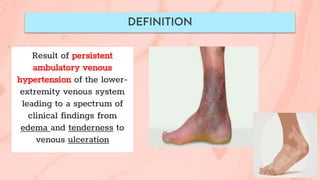 Lower Extremity Venous Reflux