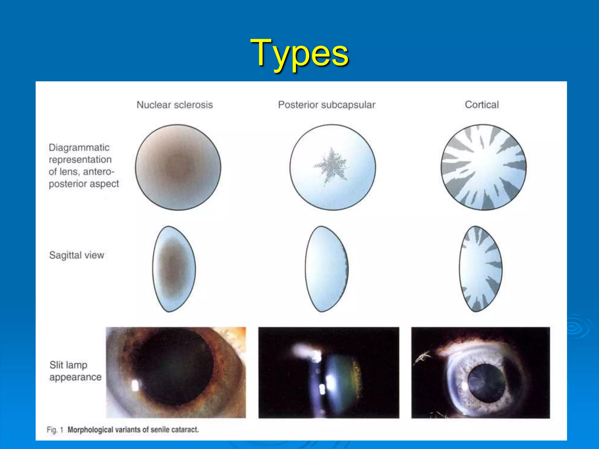 Chronic visual loss | PPTX