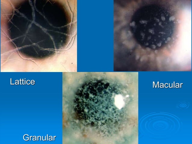 Chronic visual loss | PPTX