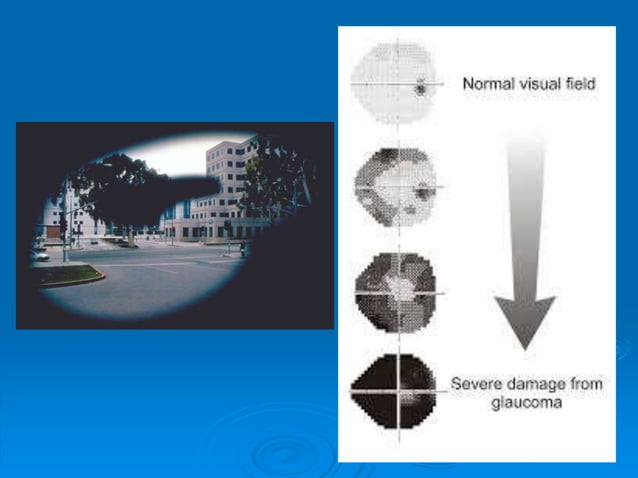 Chronic visual loss | PPTX