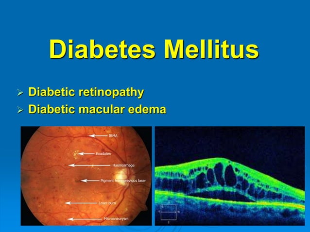 Chronic visual loss | PPTX