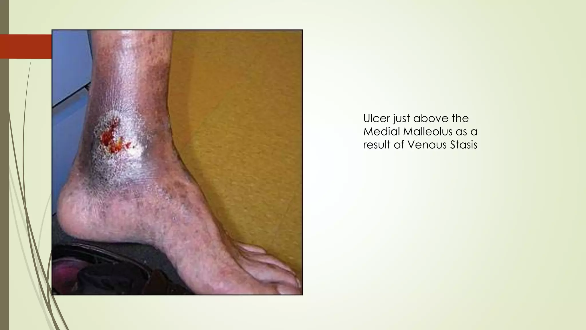 Chronic wounds | PPTX