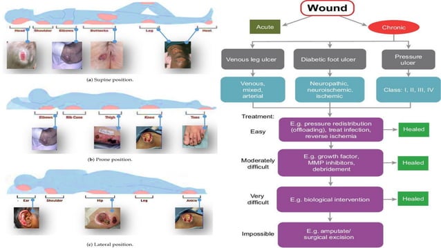 Chronic Wounds | PDF | Death, Injury, or Military Conflict | Sensitive ...