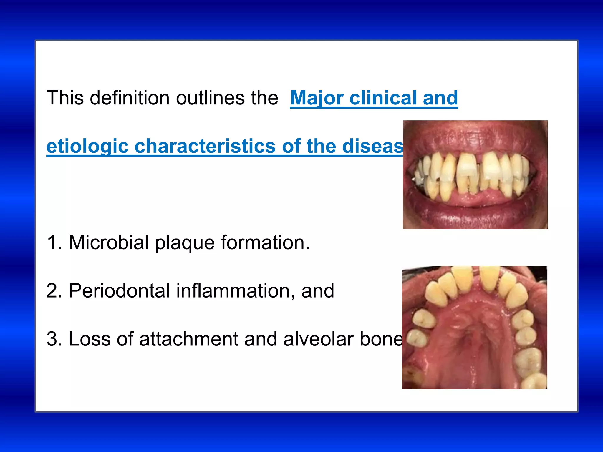 Chroni periodontitis | PPTX