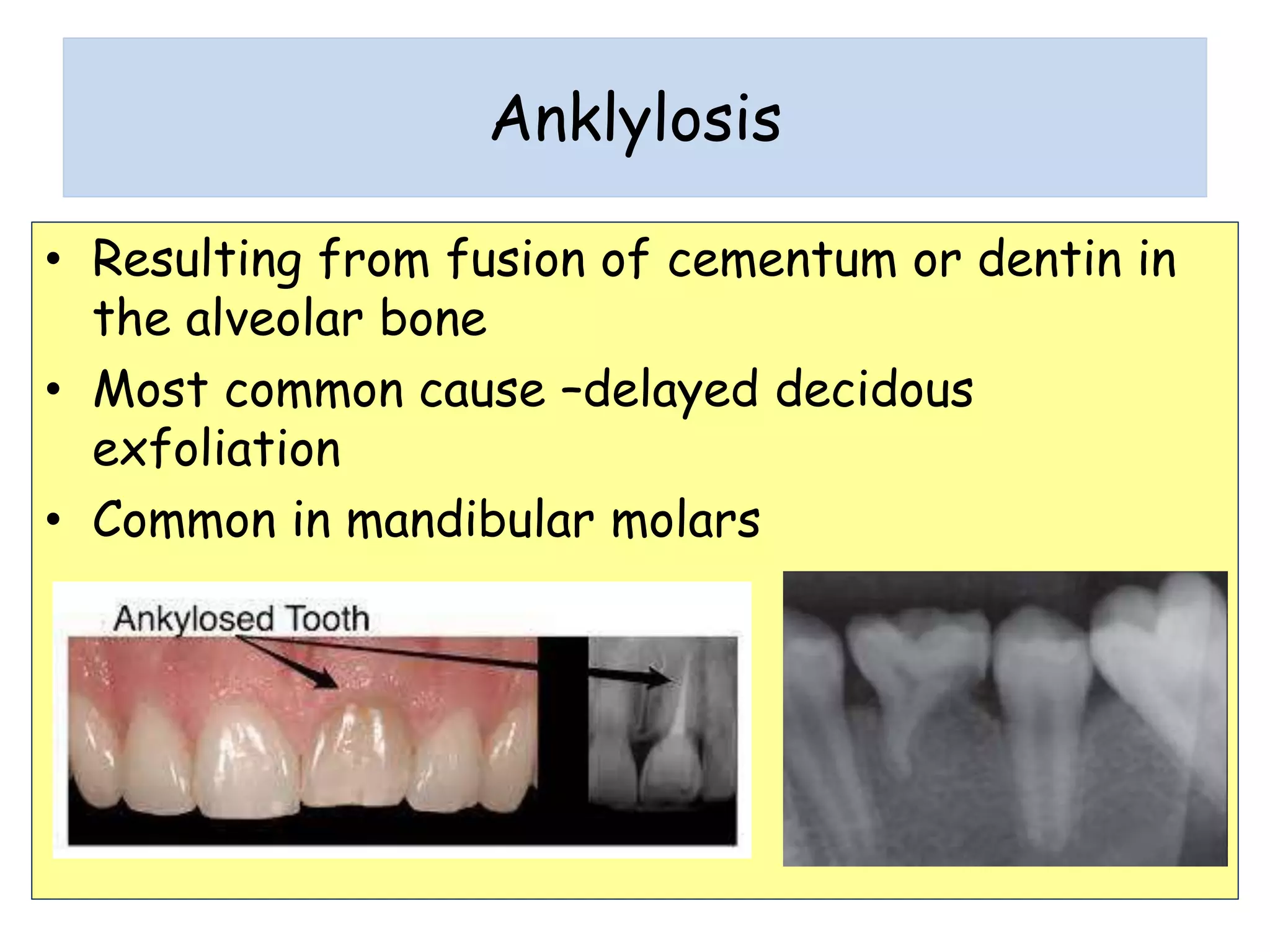 Chronology, Eruption disorders, importance of first permanent molar ...