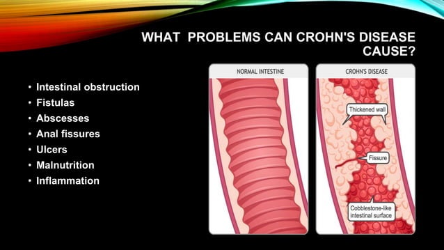 Chrons Diseasepptx