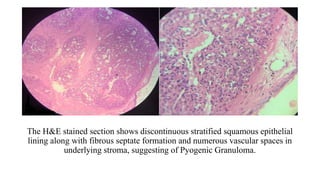 Chronic Pyogenic Granuloma | PPTX