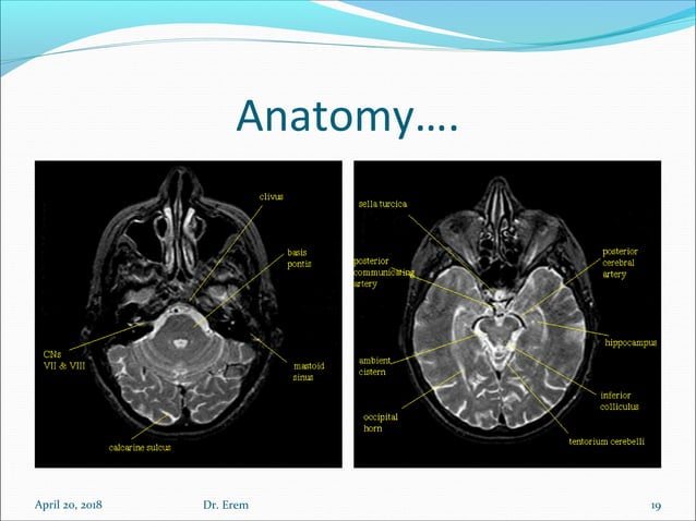 Chs 3111 cns pathology radiology | PPT | Brain and Nervous System ...