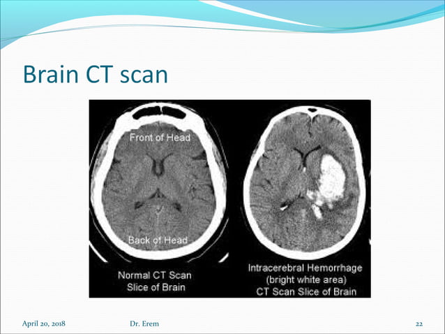 Chs 3111 cns pathology radiology | PPT | Brain and Nervous System ...