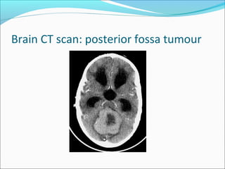 Chs 3111 cns pathology radiology | PPT